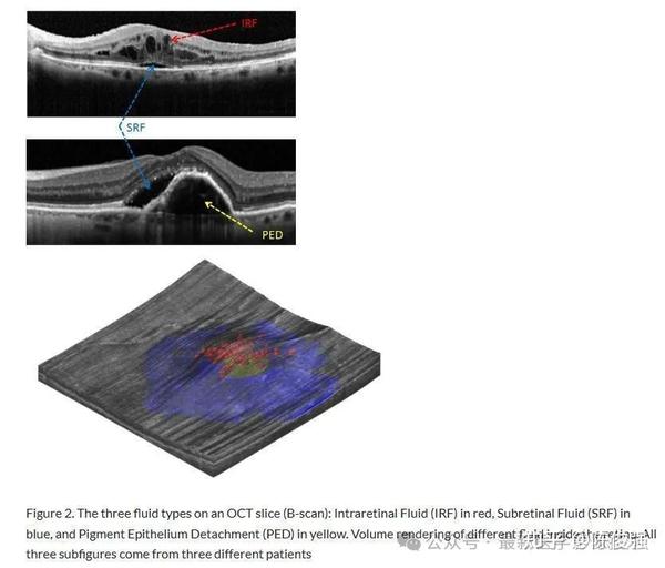 RETOUCH2017——视网膜OCT积液分割挑战赛 - 知乎