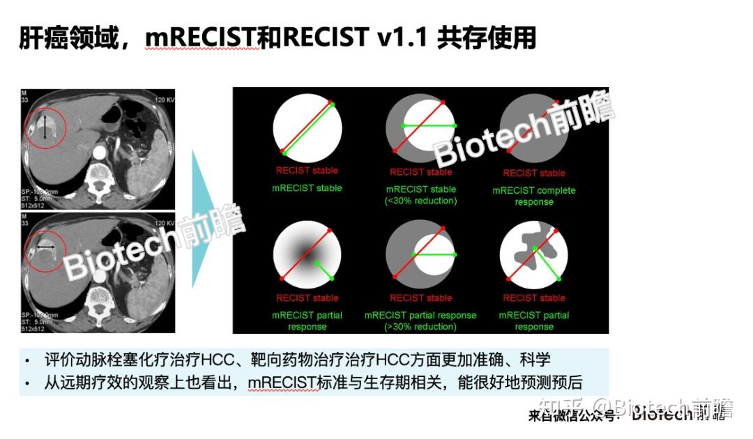 试验设计课堂丨读懂实体瘤疗效（RECIST1.1、mRECIST等）评估 - 知乎
