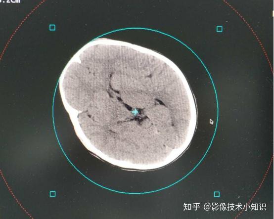 CT的扫描野和显示野 - 知乎