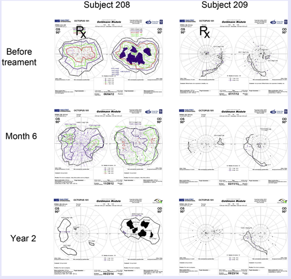 腺相关病毒AAV在眼科中应用研究 - 知乎