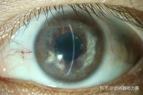 Cogan综合征诊治的研究进展 - 知乎