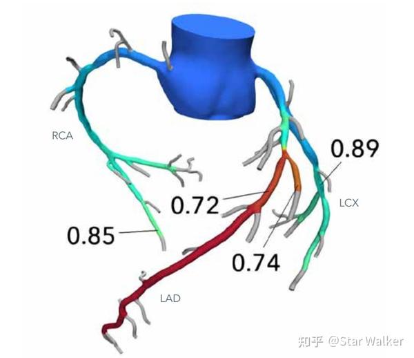 关于冠脉血流储备分数FFR、QFR、FFRCT的简单笔记 - 知乎