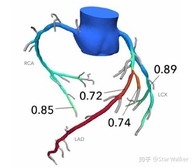 关于冠脉血流储备分数FFR、QFR、FFRCT的简单笔记 - 知乎