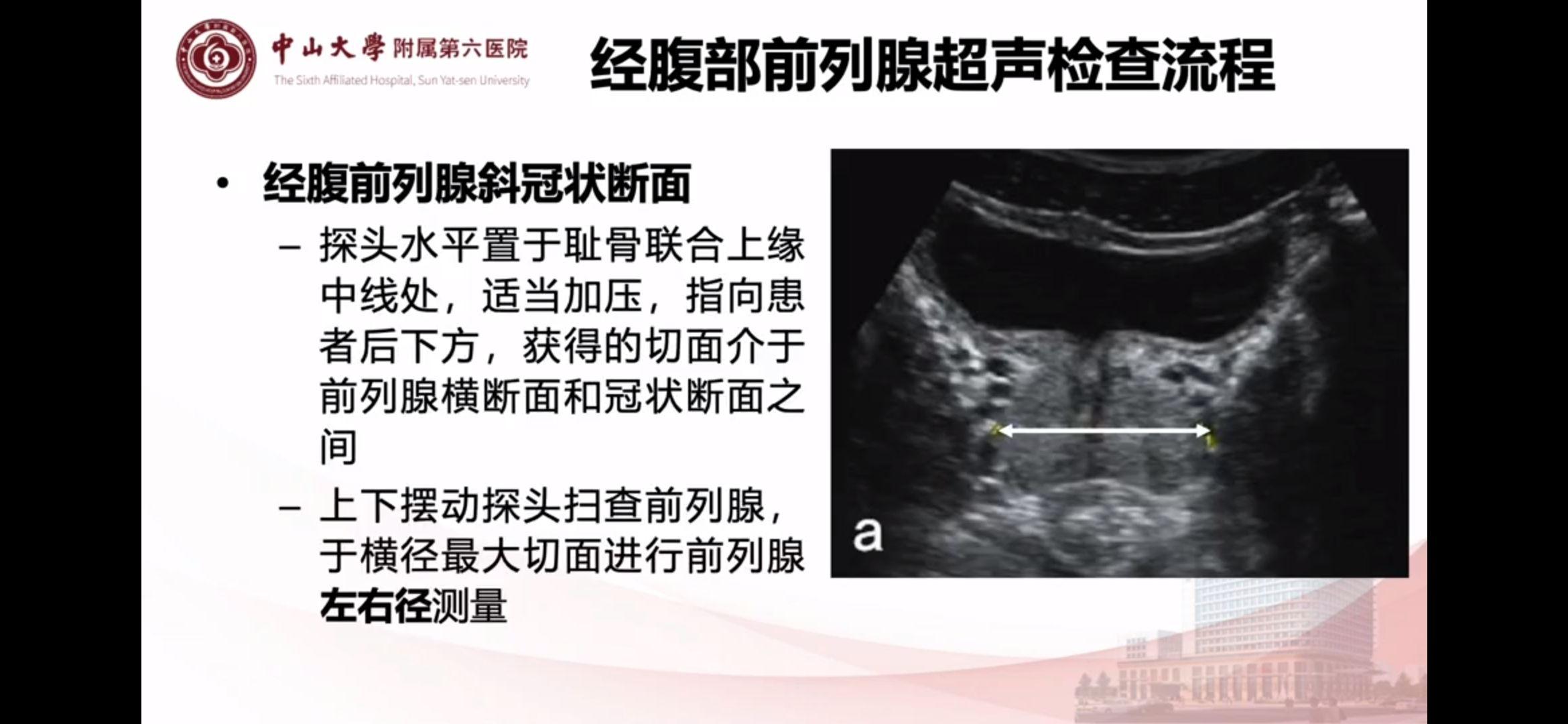 经腹部前列腺超声及残余尿测定检查流程 知乎