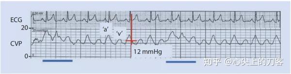 正确理解中心静脉压（CVP） - 知乎