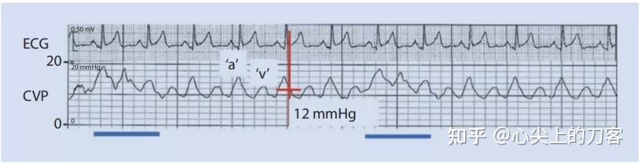 正确理解中心静脉压（CVP） - 知乎