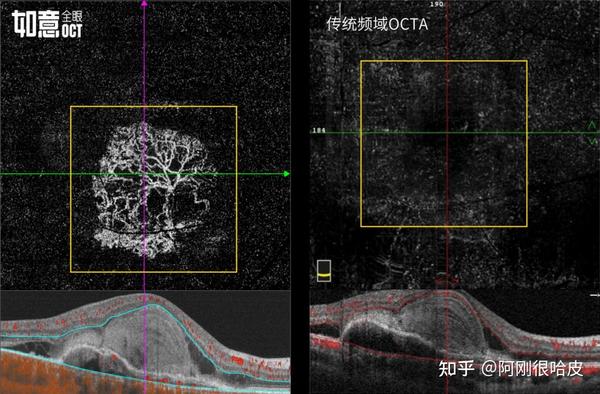 眼科OCT和OCTA到底是啥？什么时候需要做？ - 知乎