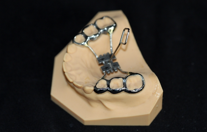 干货分享：固定式扩弓器——Hyrax扩弓器的全面指南！值得收藏 - 知乎