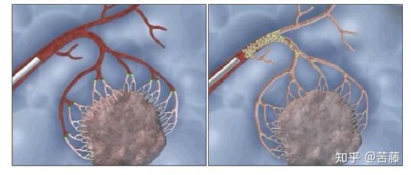 肝癌介入治疗（TACE）的发展与解构 - 知乎