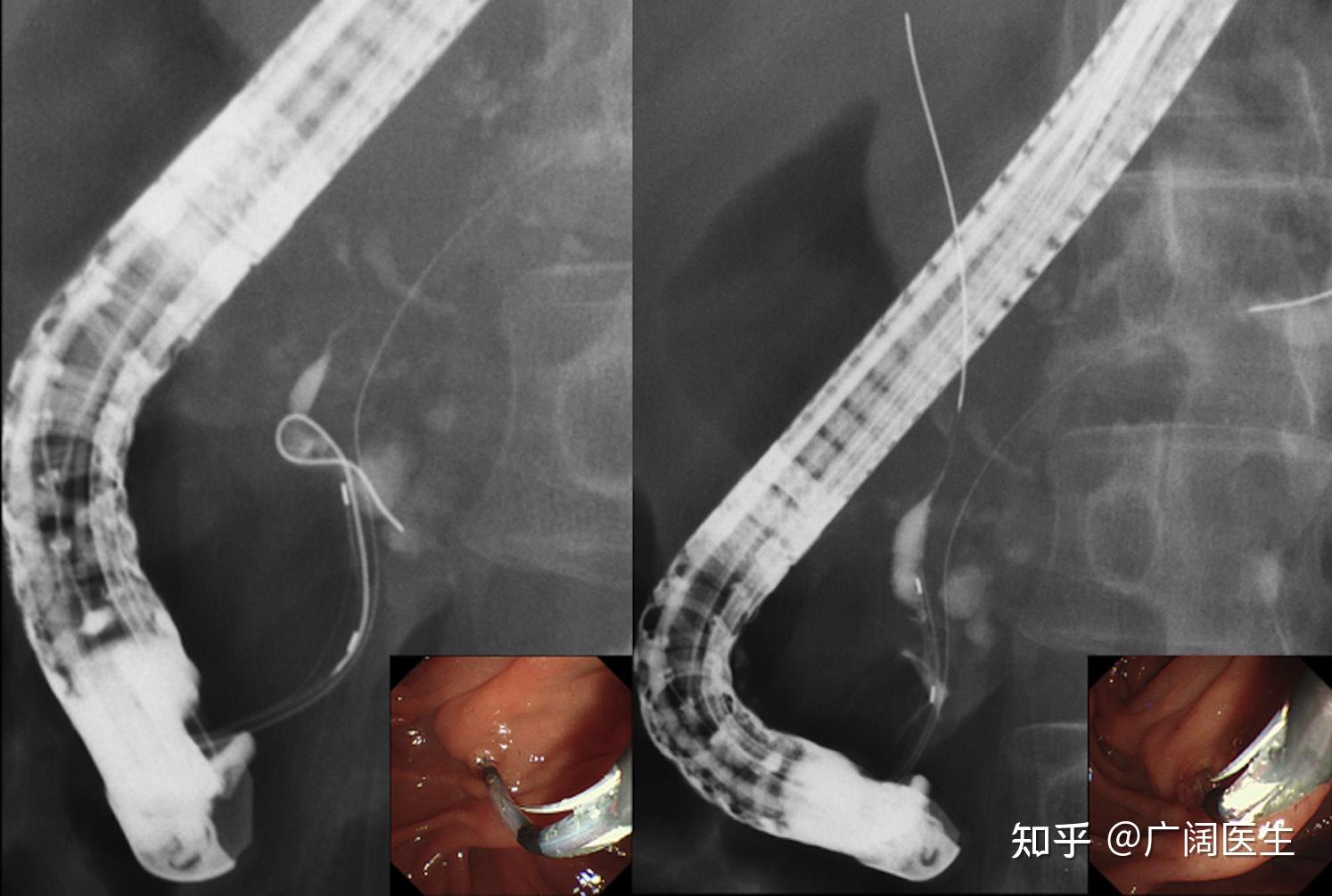 介绍一种新的ERCP切开刀--4腔（2导丝2注射腔） - 知乎