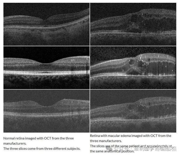 RETOUCH2017——视网膜OCT积液分割挑战赛 - 知乎