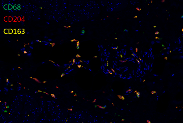 肿瘤微环境蛋白标志物怎么选？ - 知乎