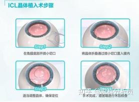 半飞秒、全飞秒、全激光、ICL四种近视手术有何区别 - 知乎