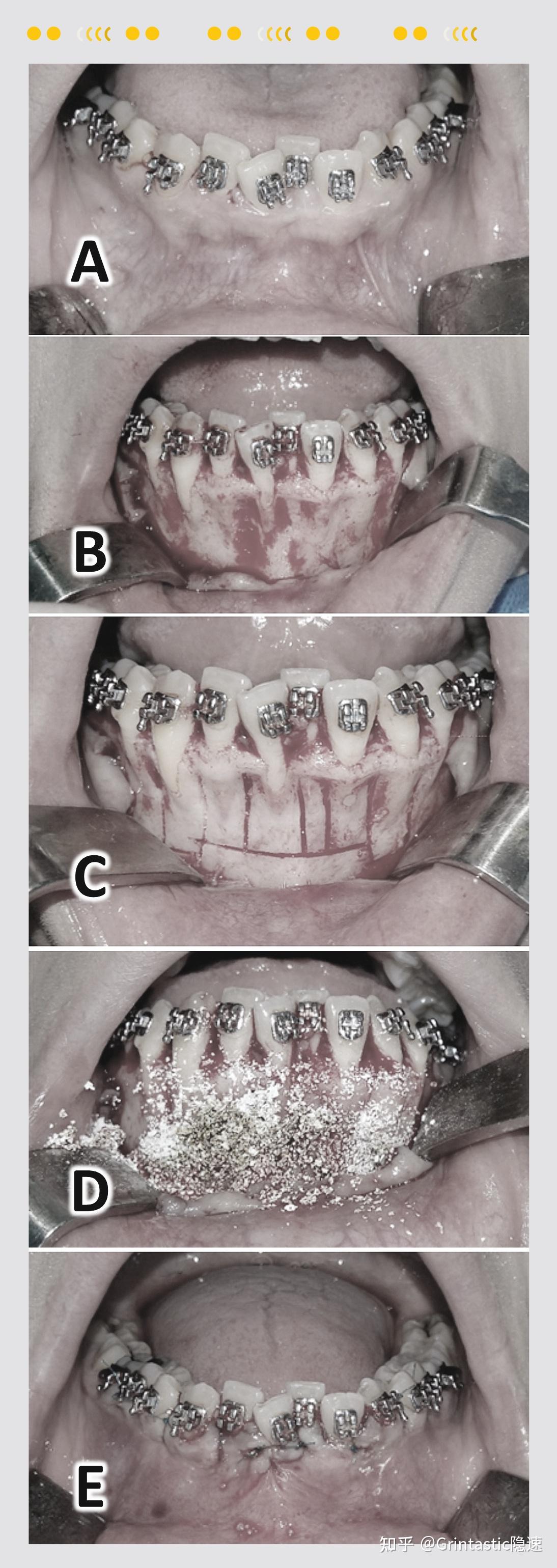 文献探析｜很疼，但是很值得：牙周加速成骨正畸（PAOO） - 知乎