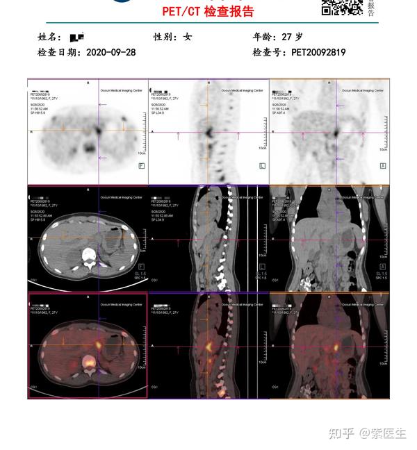年轻女孩手脚淤青，PET/CT诊断为胃癌伴全身转移 - 知乎