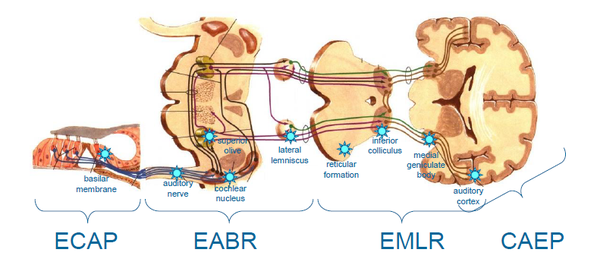 临床听力学技术专业沙龙 | 鲁兆毅：电刺激听觉诱发电位在人工耳蜗植入中的应用 - 知乎