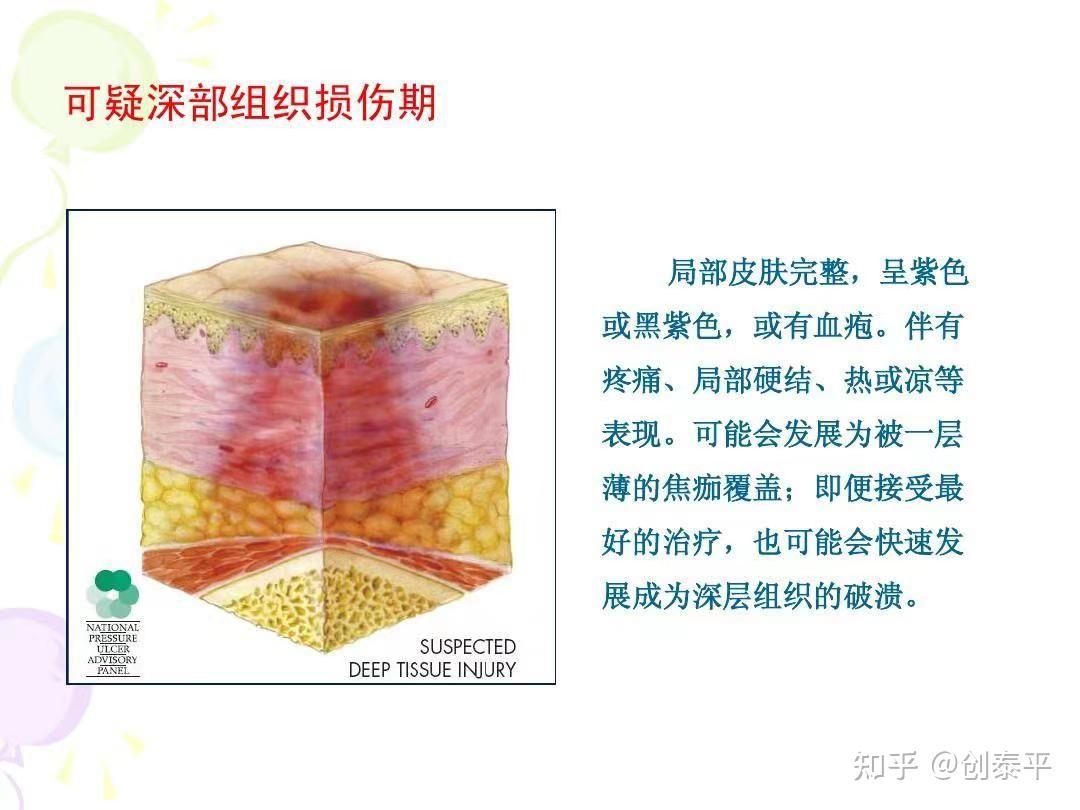 压疮（褥疮）的特点、分类及危害 - 知乎