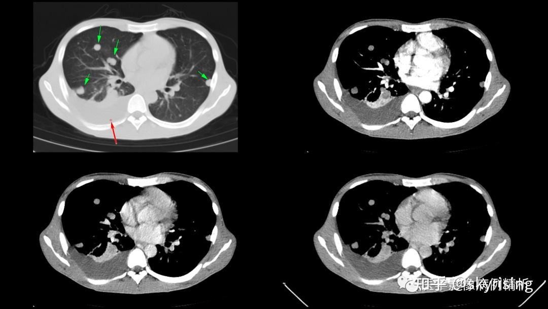 浅谈CT增强技术对影像图片显示质量影响及解决方法并肝脏恶性肿瘤、多发转移报告范例（全文） - 知乎
