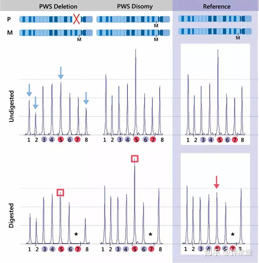 Prader-Willi(PWS)综合征的基因检测 - 知乎