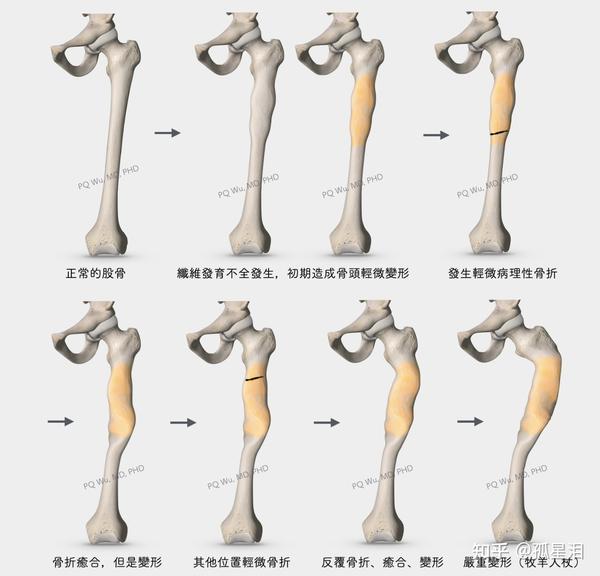 【罕见病】埃及狮身人面像的原型？骨性狮面症（Leontiasis ossea） - 知乎