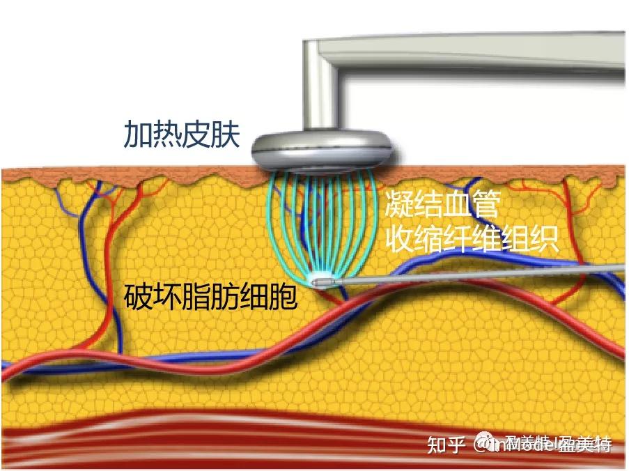 EMBRACE RF钻石精雕让你的脸更精致 - 知乎