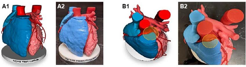 【Simpleware】Nicklaus儿童医院利用人工智能技术加速3D打印心脏模型 - 知乎