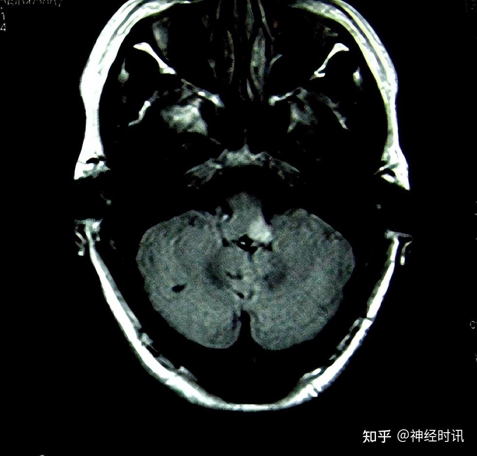 脑血管疾病如何定位诊断？解剖生理及病损表现又有哪些？ - 知乎