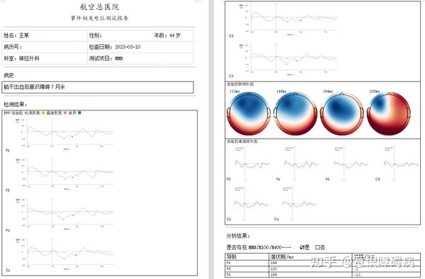“促醒·困住的大脑”系列（四）：事件相关电位对慢性意识障碍的诊断和预后评估的应用案例 - 知乎