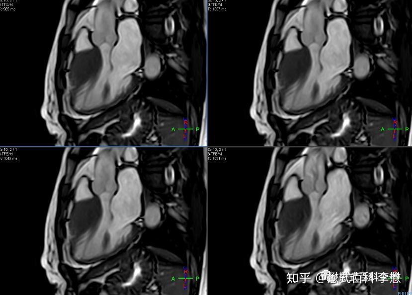 MRI图像扫描角度和图像方位问题探讨 - 知乎