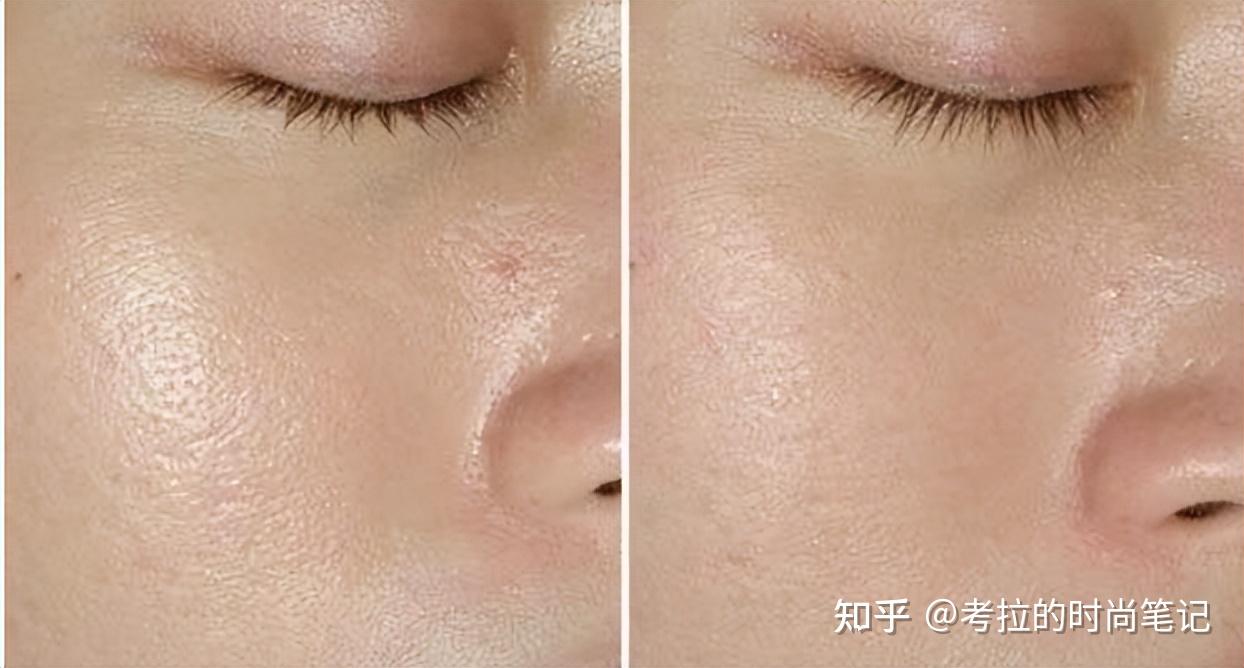 如何改善毛孔粗大?教你几招照着做,不仅毛孔变小,皮肤也更细腻 知乎