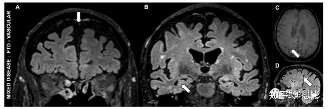 Radiology：神经影像学在痴呆症中的应用 - 知乎
