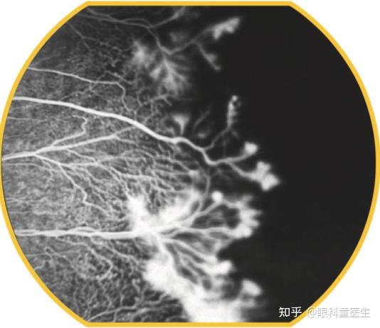 视网膜血管性疾病——4、家族性渗出性玻璃体视网膜病变 - 知乎