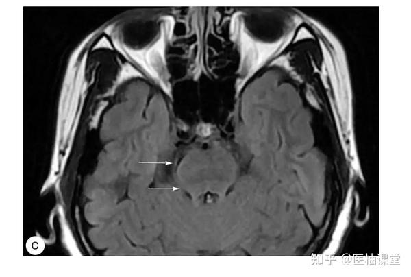【收藏】十二对脑神经影像解剖图谱 - 知乎