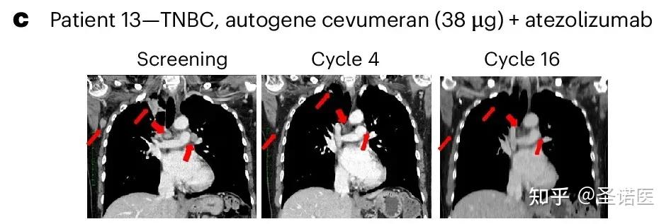个体化mRNA癌症疫苗BNT122(Autogene Cevumeran、RO7198457)帮患者肿瘤缩小近10倍，多癌种晚期患者获益显著 - 知乎