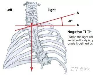 脊柱畸形角度测量 - 知乎