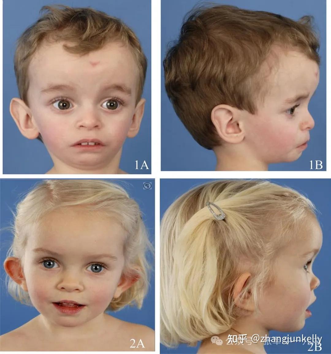 SRS(Silver-Russell syndrome，罗素银综合征) - 知乎