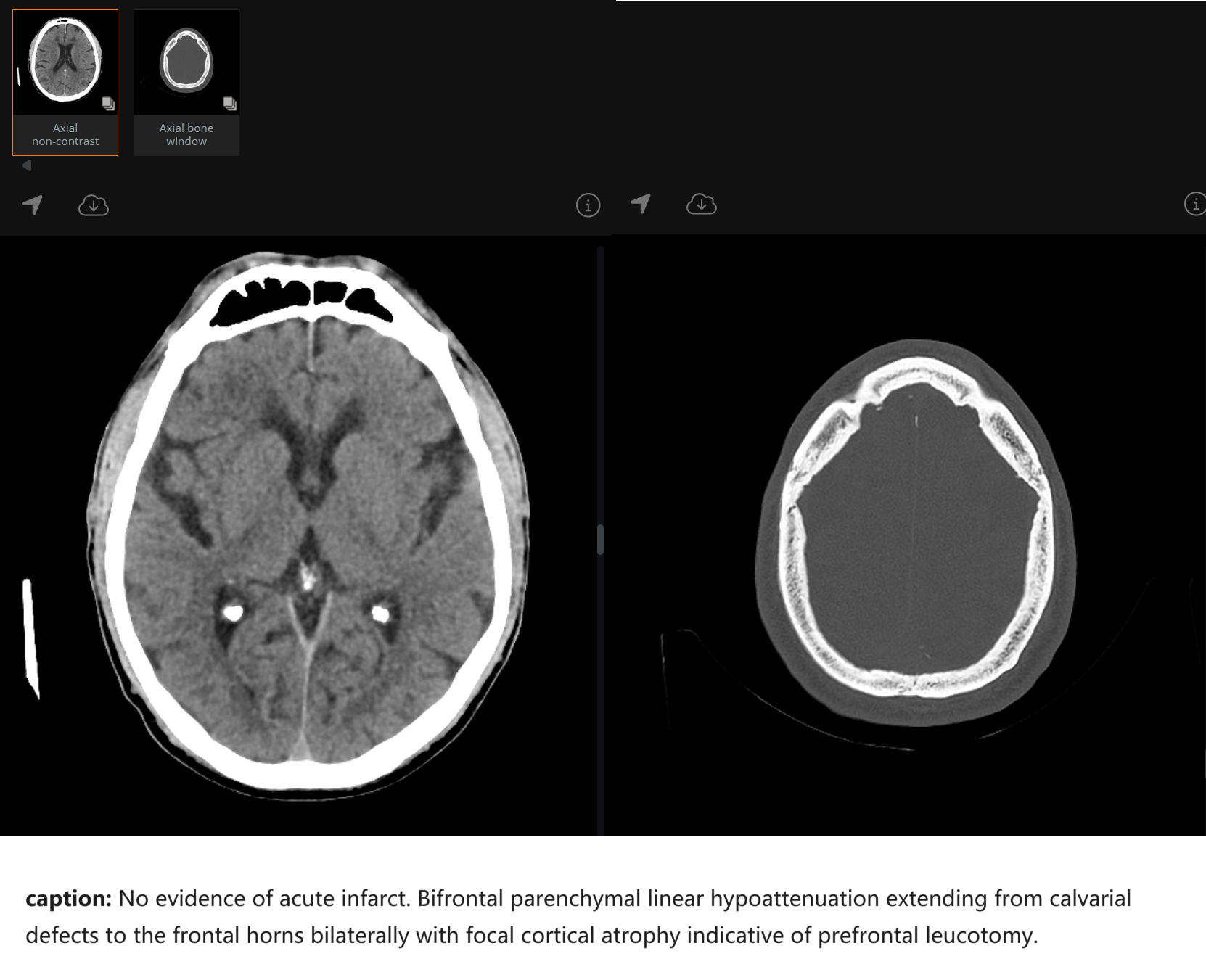 RP3D-Caption 数据集介绍：RadioPaedia 网站的 3D 医学影像和描述的图文对 - 知乎