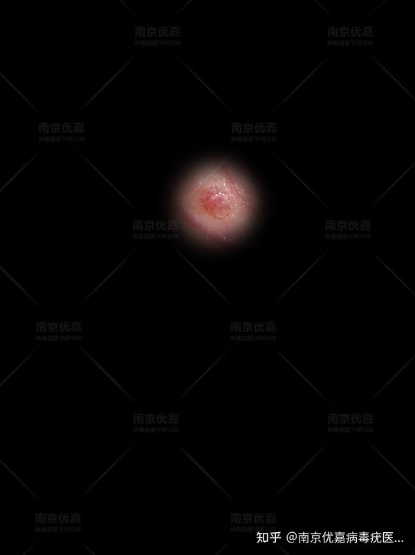 尖锐湿疣图片合集（多图慎入） 知乎 