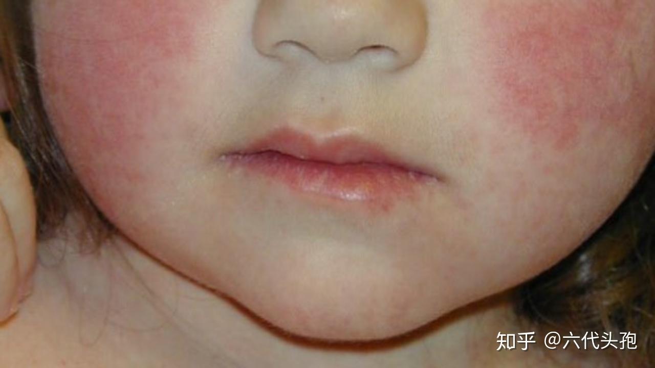 用口诀学会儿科出疹性疾病 - 知乎