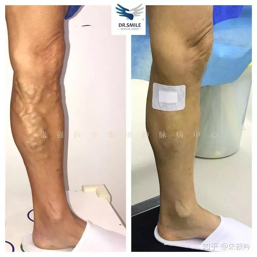 CHIVA治疗下肢静脉曲张：优势与结果 - 知乎