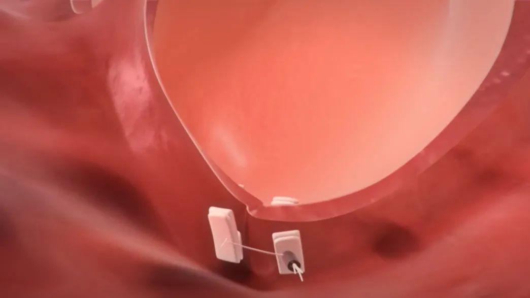 全面解析二尖瓣反流，10条要点全概括! - 知乎