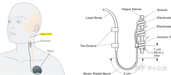 迷走神经——浅谈四（迷走神经刺激的几种方式） - 知乎