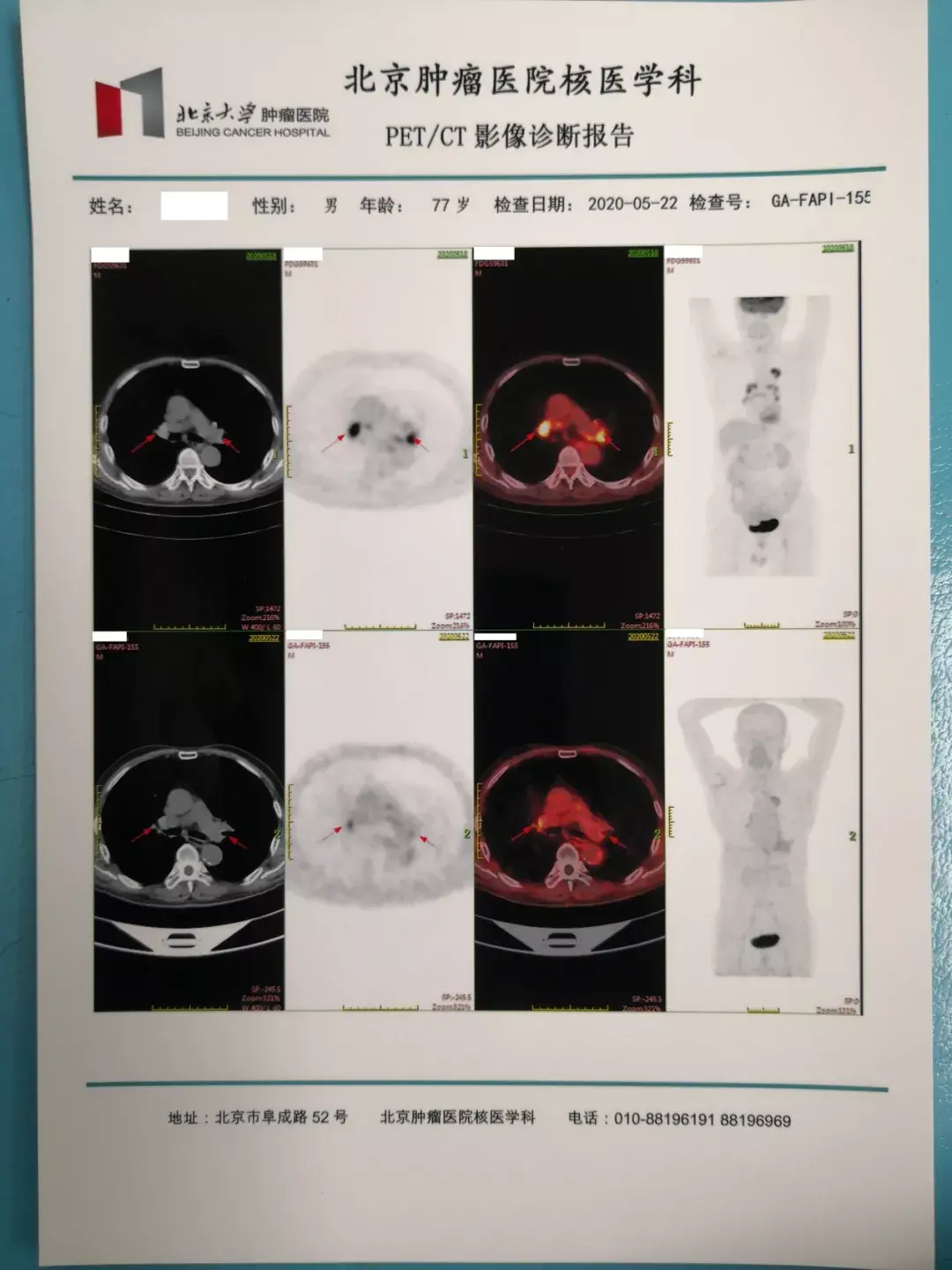 新型PETCT检查（FAPI） ——肿瘤分期的好帮手 - 知乎