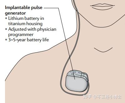 【脑机】脑深部电刺激技术：现状和未来方向（三） - 知乎