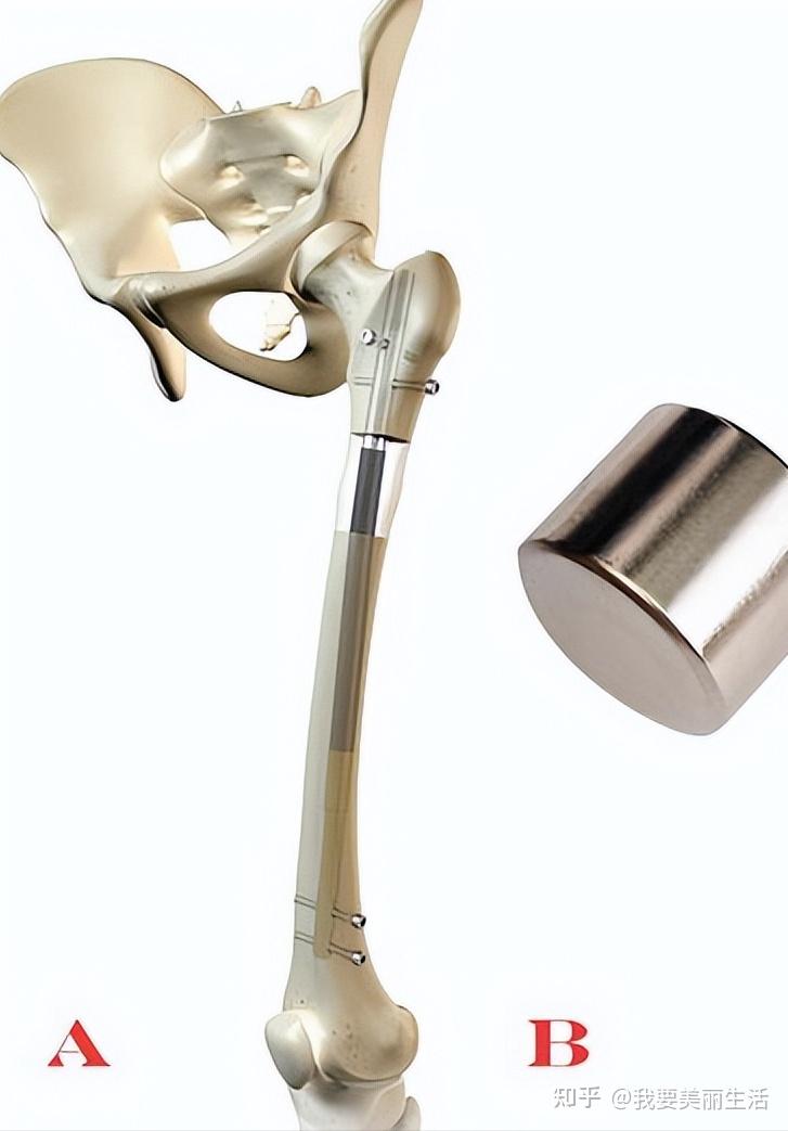 科普德国骨科增高历史新发展和他的新技术 - 知乎