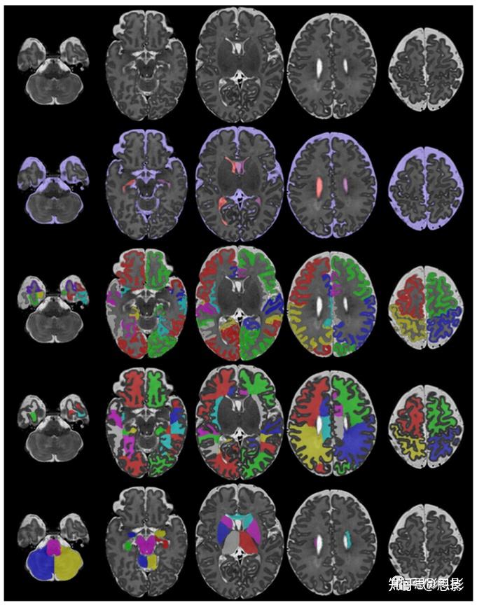 NeuroImage:胎儿和新生儿大脑MRI自动分割 - 知乎