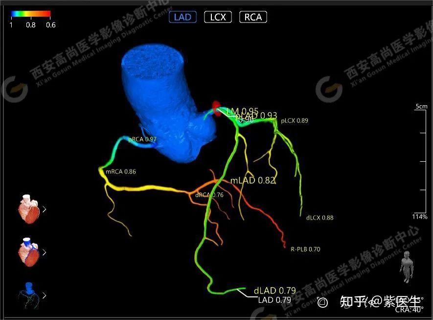 高尚医学影像之冠状动脉CT血流储备分数AI定量分析（CT-FFR） - 知乎