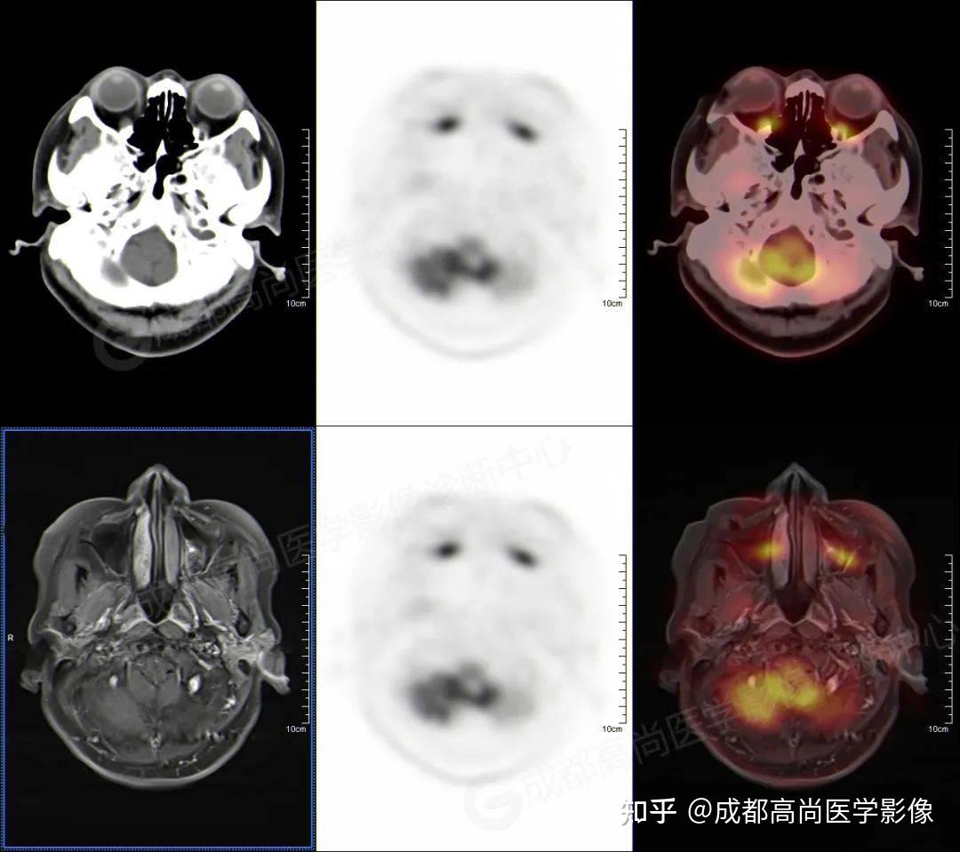【高尚病例】PET-CT/MRI多模态检查实现“一站式”诊断 - 知乎
