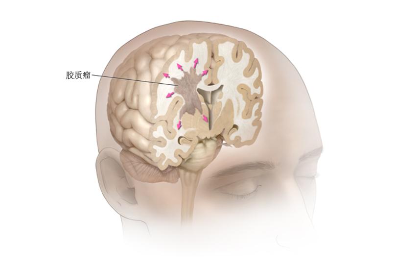 2级IDH突变型胶质瘤迎来首个靶向疗法——Voranigo，已在美获批上市 - 知乎