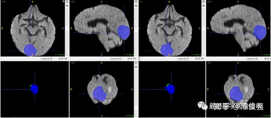 BraTS2023-MEN——BraTS2023颅内脑膜瘤分割挑战赛 - 知乎